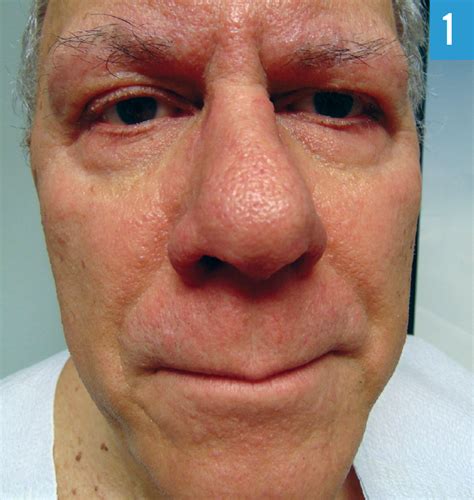 What Explains A Mans Papular Eruption And Madarosis After Cardiac