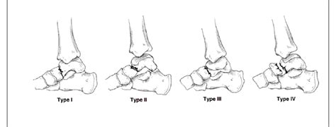 Types Of Talus Fractures Hindfoot Fractures Orthopaedia