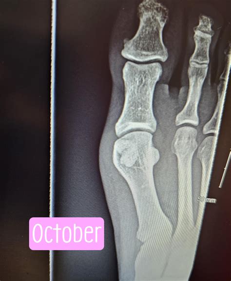 Sesamoid Fracture R Sesamoid