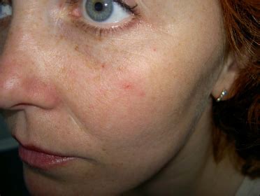 Treatment Of Spider Angioma With Copper Vapour Laser Radiation 578 Nm