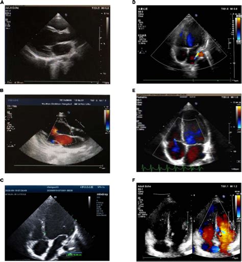 Preoperative And Postoperative Echocardiography Of Atrial Tachycardia