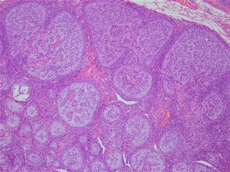 Pathology Outlines Sex Cord Tumor With Annular Tubules