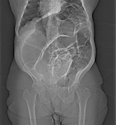 Emergency Medicine Educationem 3am Sigmoid Volvulus Emergency