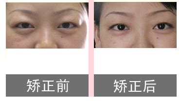 肿眼泡吸脂前后对比 肿眼泡前后对比 肿眼泡抽脂 大山谷图库
