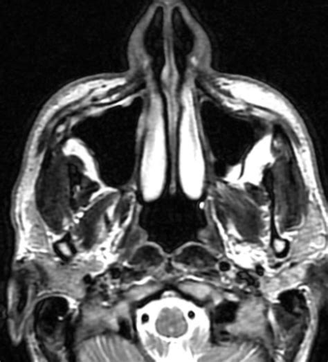 Unclear Diagnosis For 3 Years Multiple Surgeries No Result Sinusitis