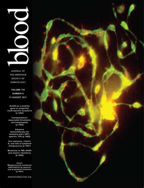 Missense Mutations In Pml Rara Are Critical For The Lack Of Responsiveness To Arsenic Trioxide