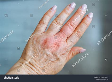 Paper Wasp Sting Swelling