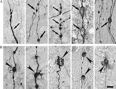 Profi Les Of Swollen Axons And Varicosities And Axonal Leakage A