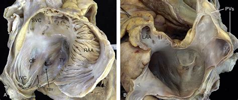 Ventricular Septal Defect Gross