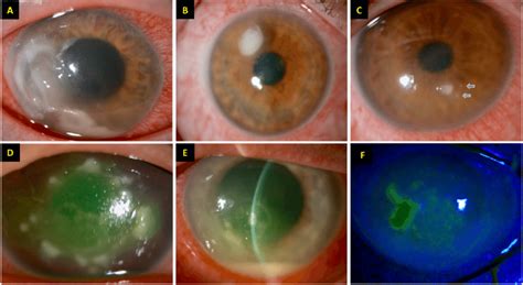 Bacterial Keratitis Symptoms Common Eye Infections Symptoms Eye