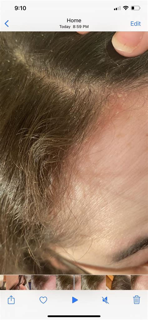 HELP How To Get Rid Of Dry Scalp Dandruff Flakes R Hair