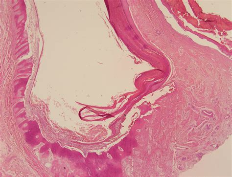 Pathology Outlines Epidermoid Inclusion Cyst
