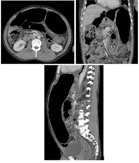 Ct Scan Findings Showing Significant Sigmoid Colonic Dilatation With