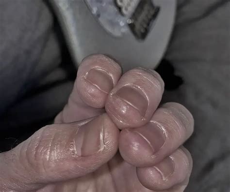 Do Guitar Calluses Go Away