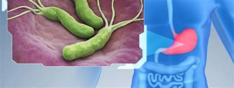 Helicobacter Pylori Infection Symptoms And Complications G And L Surgical
