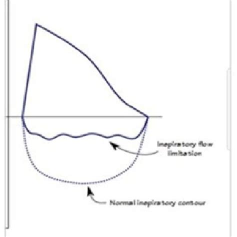 Vocal Cord During Normal Inspiration Left And In Patient With Vocal Download Scientific Diagram