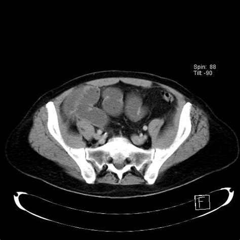 Radiopaedia Case Perforated Appendix Id 39321 Study 41574 Nc Commons