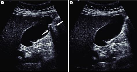 Duodenal Gas Mimicking Gallstone A Ultrasound Reveals An Echogenic Download Scientific