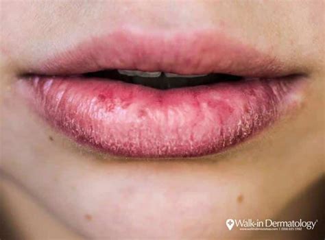 How To Heal Severely Chapped Lips My Glow Journey