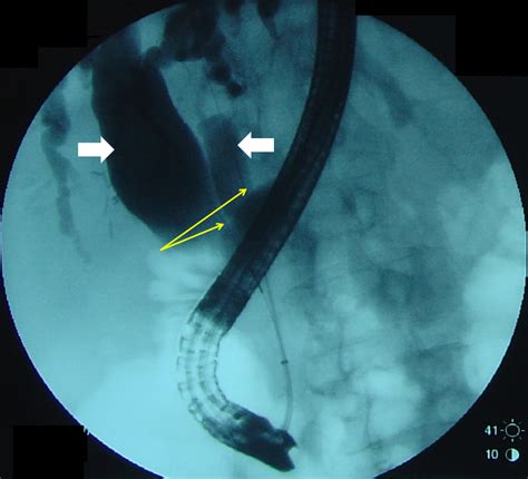 Ercp Showing Type Va Extrahepatic Bile Duct Duplication Right And Left Download Scientific