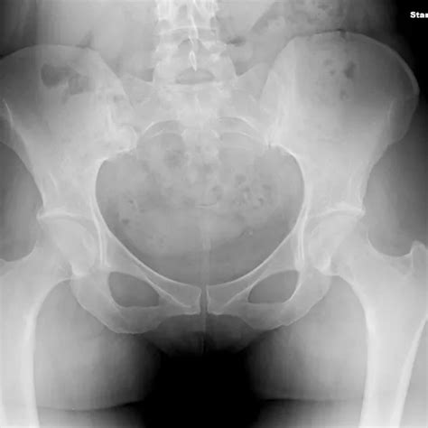 X Ray Pelvis Ap And Lateral View Test Price In Delhi Ganesh Diagnostic