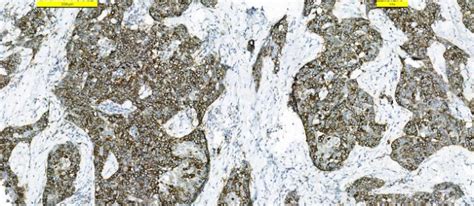 Immunohistostaining Cd117 Positive In Tumor Cells Download