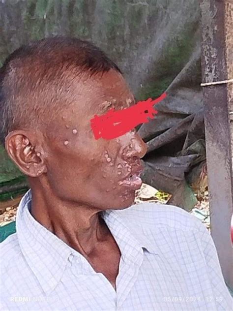 ကျိုက်ထိုမြို့တွင် တွေ့ရှိခဲ့သည့် မျောက်ကျောက်သံသယလူနာမှာ ဓာတ်ခွဲအဖြေအရ