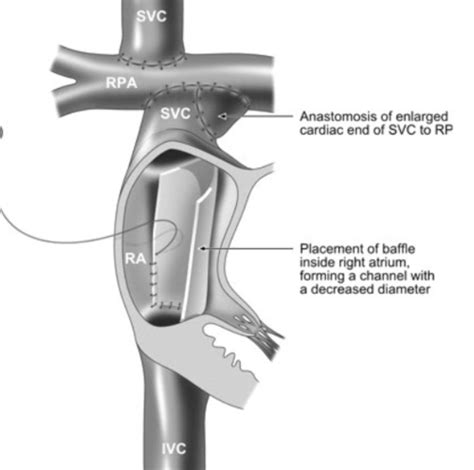 Week 6 Fontan Procedure And Segmental Anatomy Flashcards Quizlet