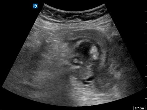 RIF Pain Critical Care Sonography