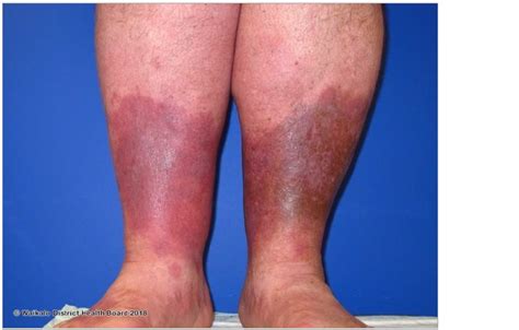 Varicose Vein Refhelp
