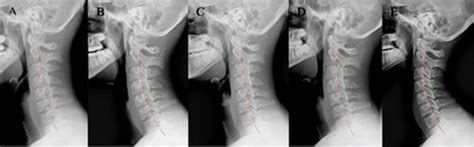 Lateral Cervical X Rays A And B Pre Post Lordosis Improvement Prior