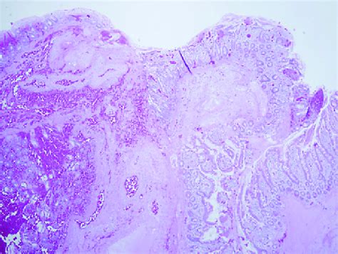 Low Power View Of A Hemorrhagic Focus Of Bowel With Transmural Defect