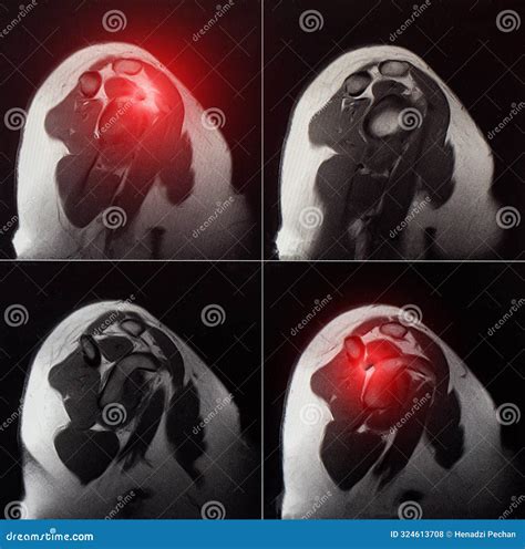 Mri Image Of The Shoulder Joint After A Fracture And Dislocation Impression Fracture Of The