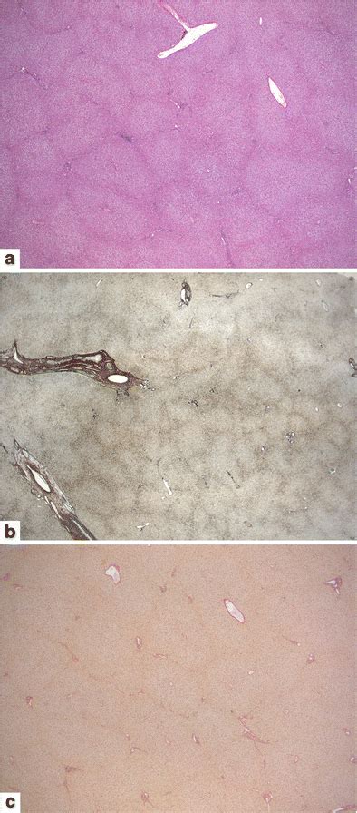 Nodular Regenerative Hyperplasia A Nodularity Is Easily Appreciated