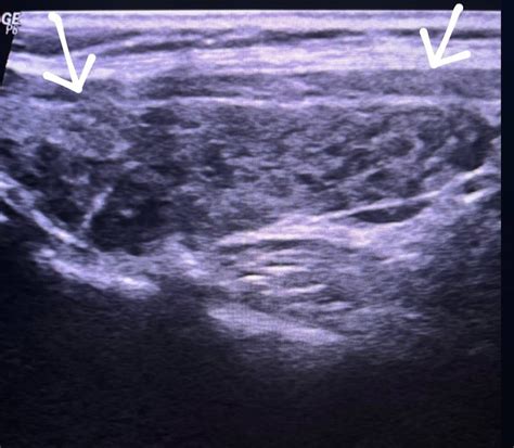 Аутоиммунный тиреоидит — главное о заболевании Evolutis Clinic Дзен