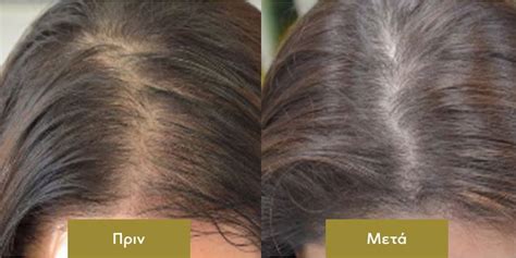 Τριχόπτωση Θεραπεία Διάγνωση Αντιμετώπιση Dermadvance