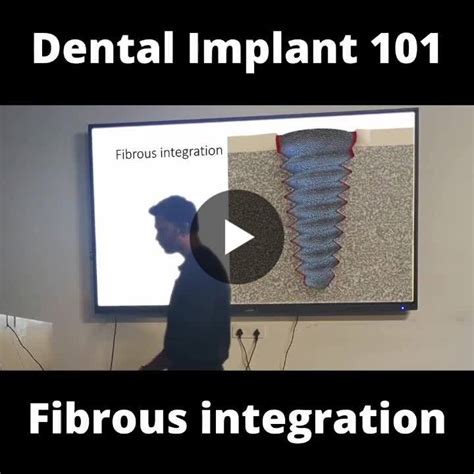 Dentalimplants Implantology Osseointegration Fibrointegration… Zibran Khan