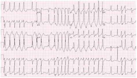 Emergency Medicine Educationecg Pointers Atrial
