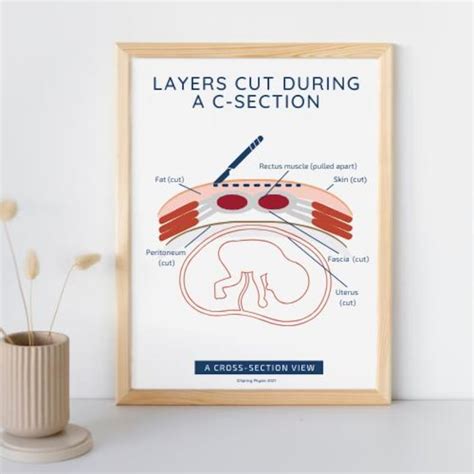 C Section Layers Art Print Midwife Pelvic Therapy Education Digital
