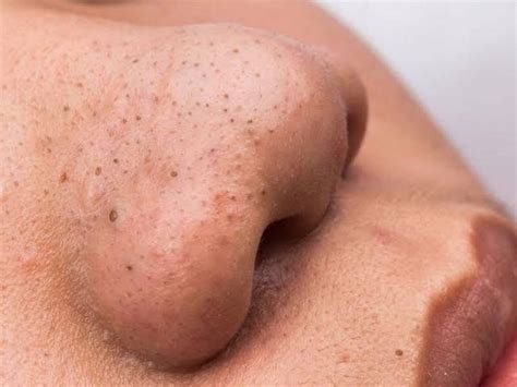 جوش‌های سرسیاه به انگلیسی Blackhead جوش‌های زیرپوستی است؛ که به عقیدهٔ متخصصان پوست