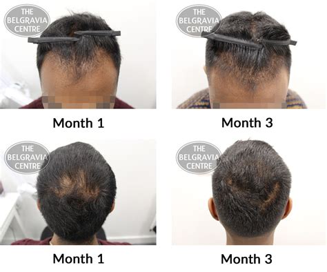 Only 3 Months Have Passed And I Am Already Seeing Significant Hair Growth