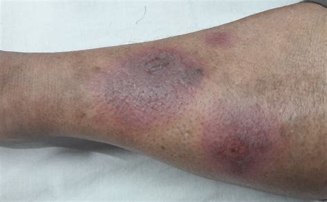 Erythema Nodosum Geeky Medics