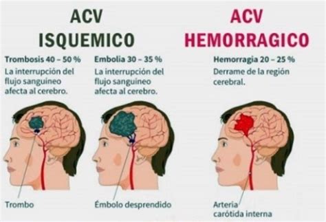 Accidente Cerebro Vascular En El Peru Cosmesalud Centro Médico