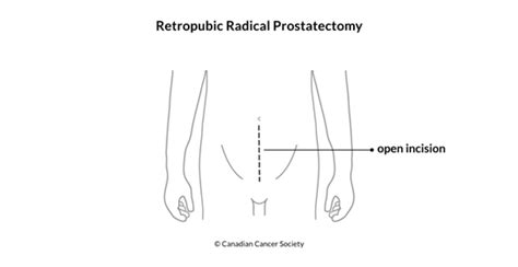 Retropubic Prostatectomy Incision