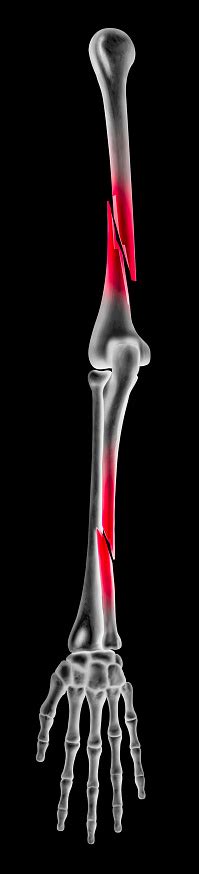 X 선 척 골 및 상 완 골 골절 이나 통증 영역 완료에 빨간 하이라이트 난민 부러진된 팔의 골절 유형 앞쪽 보기3d 의료 생물 의학 그림건강 관리절연 검은 배경에 X