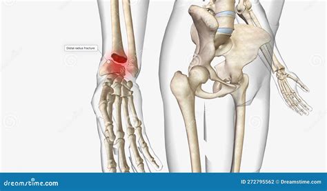 Distal Radius Fractures Are Among The Most Common Types Of Fractures And Are Most Common In The