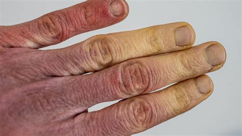 Frostbite Symptoms And Treatment