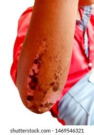 Scabs Images Stock Photos Vectors Shutterstock