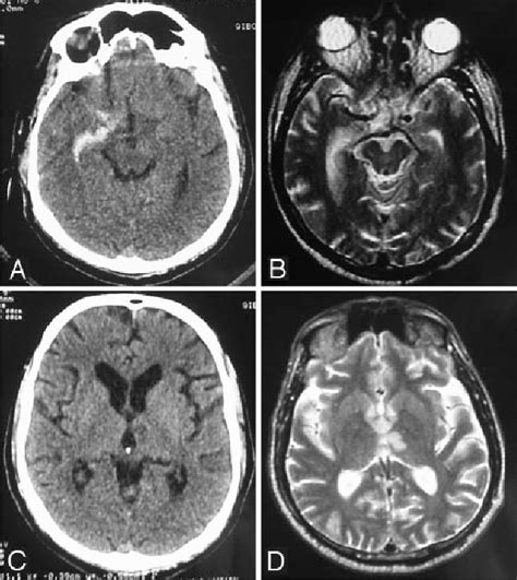 Figure 1 From Acute Korsakoff Like Amnestic Syndrome Resulting From Left Thalamic Infarction