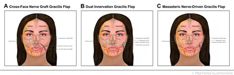 Microvascular Gracilis Free Flap Atlas Of The Oral And Maxillofacial